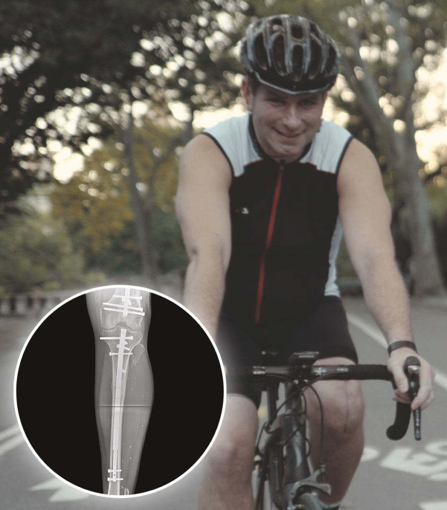 A Revolutionary Treatment Option for Patients with a Limb Length Discrepancy